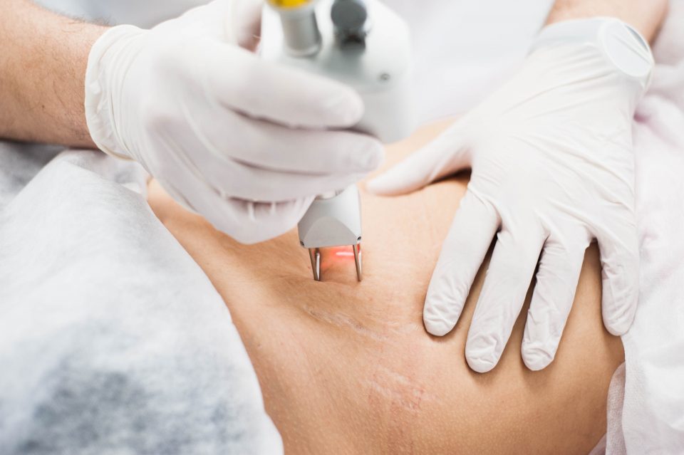 Vergeture blanche : comment s'en débarrasser naturellement