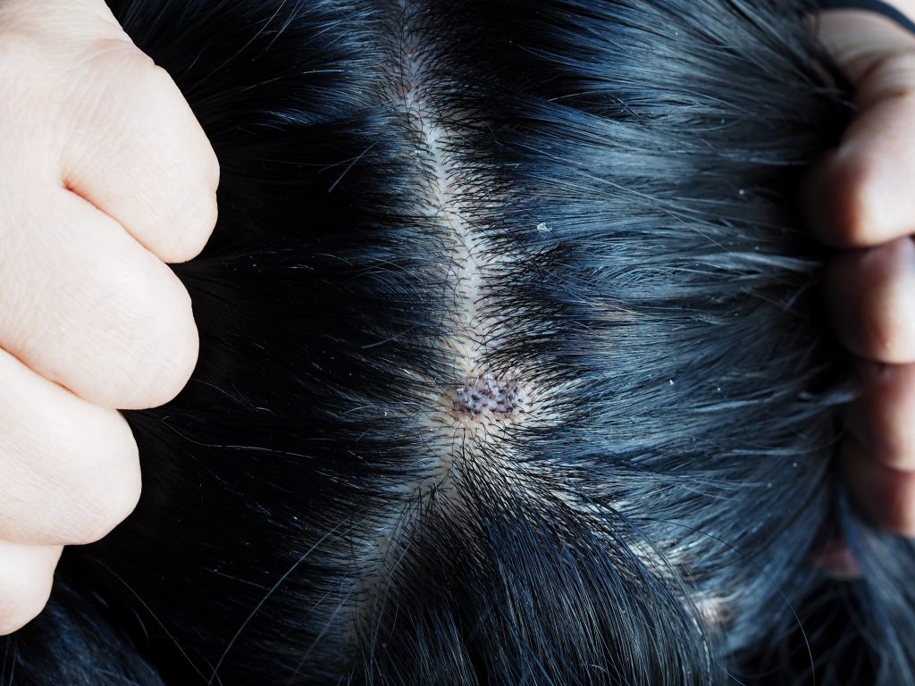 Comment vous débarrasser de l'eczéma du cuir chevelu