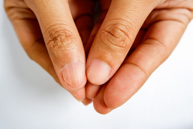 Infiltration de l’ongle : les causes et les traitements efficaces