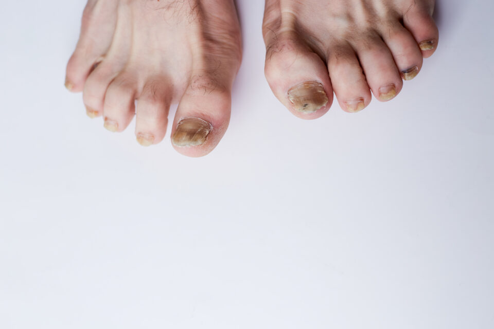 Mycose du pied : comment traiter le pied d'athlète